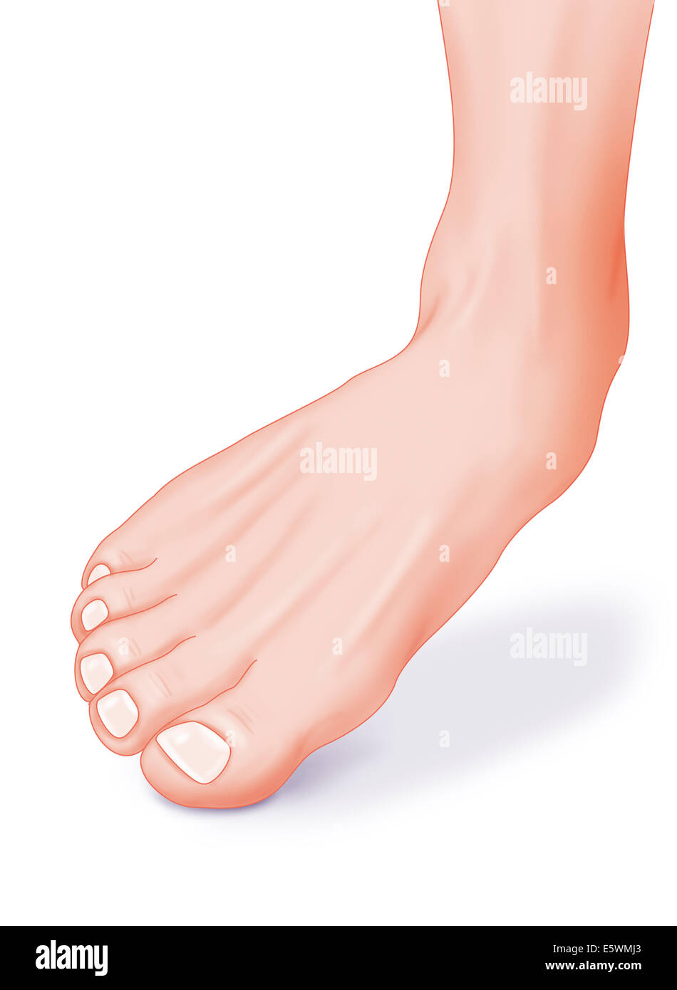 Sprained ankle, drawing Stock Photo - Alamy