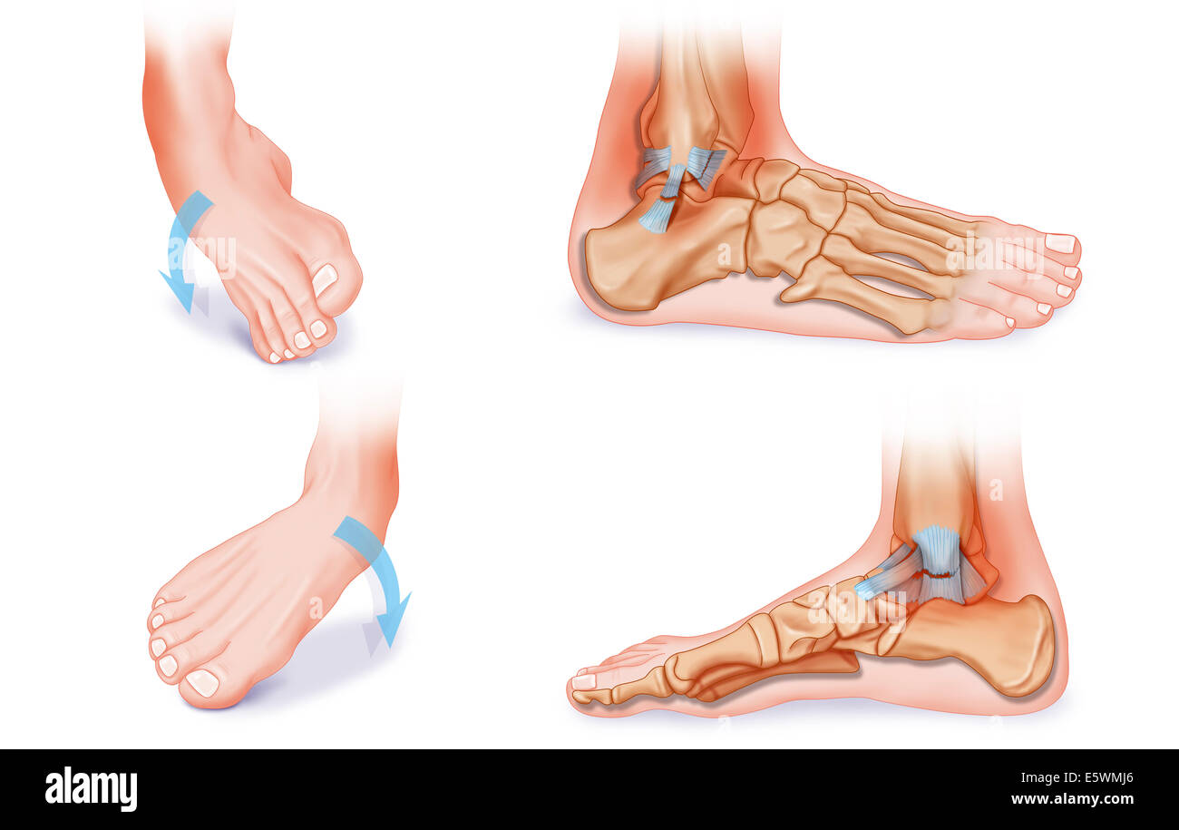 Sprained ankle, drawing Stock Photo - Alamy