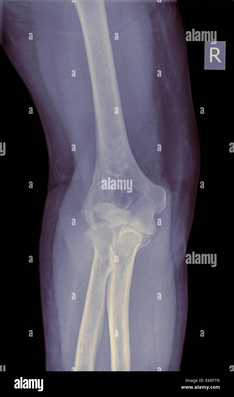 X ray of a fractured elbow (Humerus bone) of a 70 year old female ...