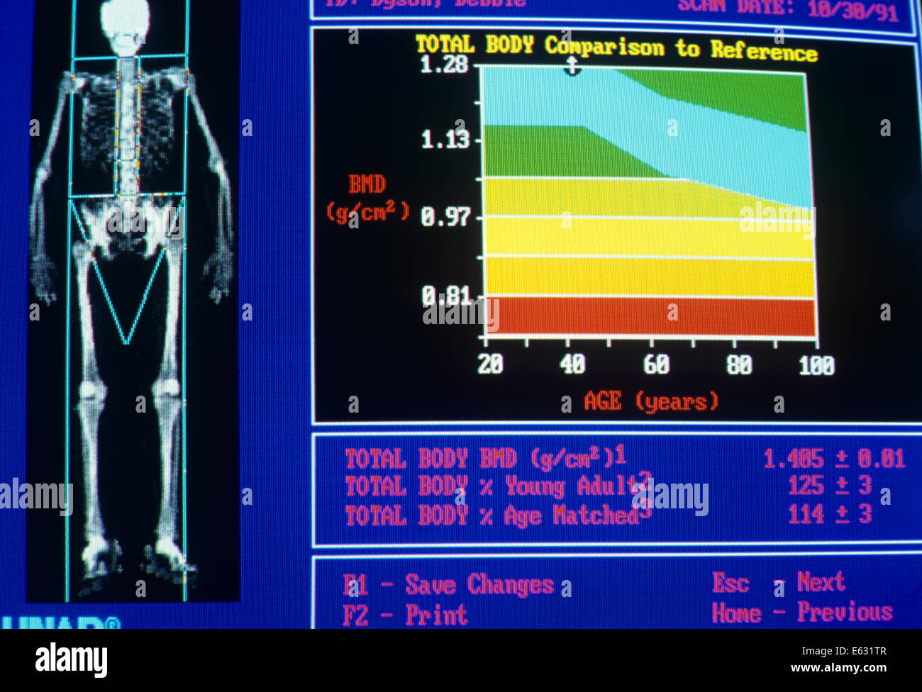 Bone density scan hi-res stock photography and images - Alamy