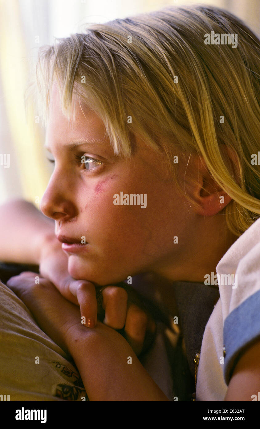 Teen girl bruised hi-res stock photography and images - Alamy