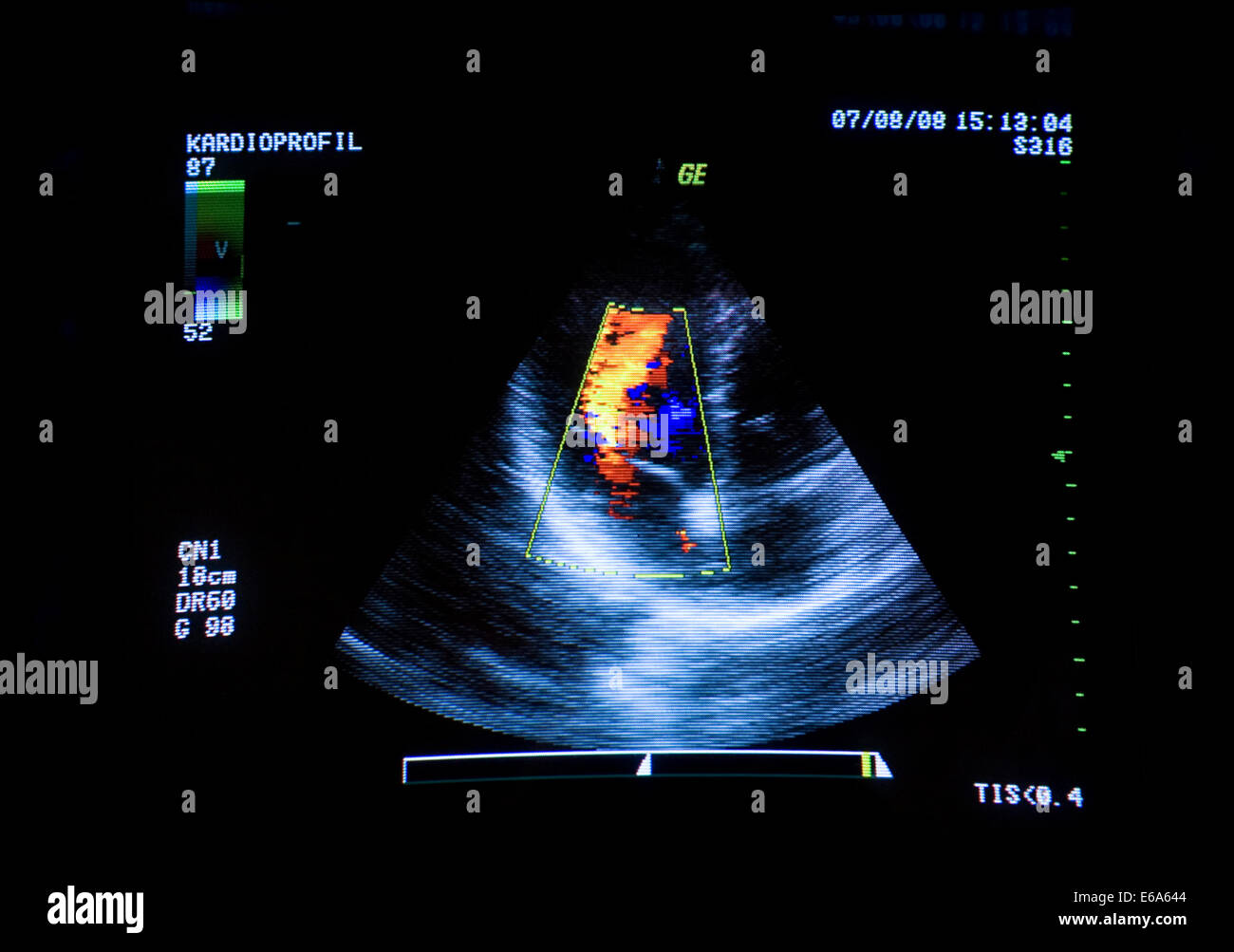 Cardiac Ultrasounds High Resolution Stock Photography and Images - Alamy