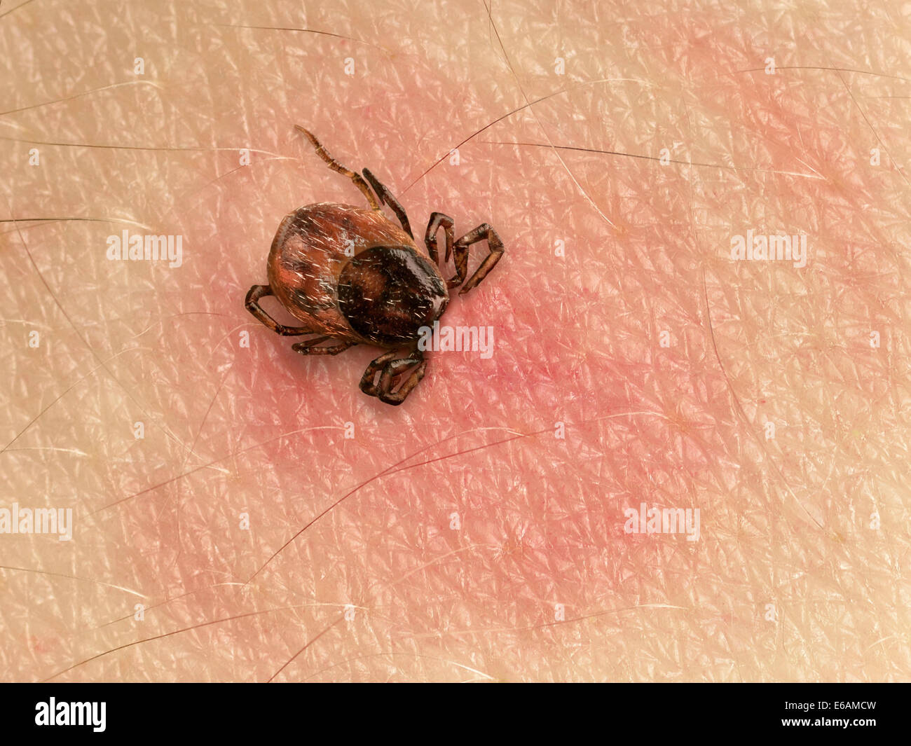 Tick bites hi-res stock photography and images - Alamy
