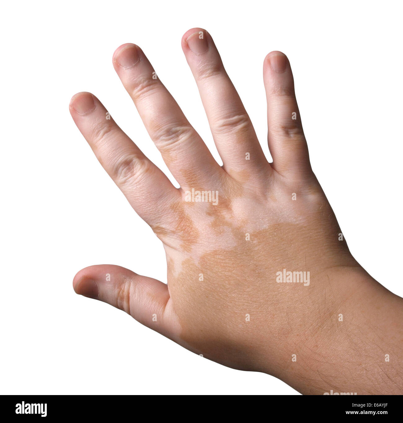 Vitiligo On Finger Skin High Resolution Stock Photography and Images ...