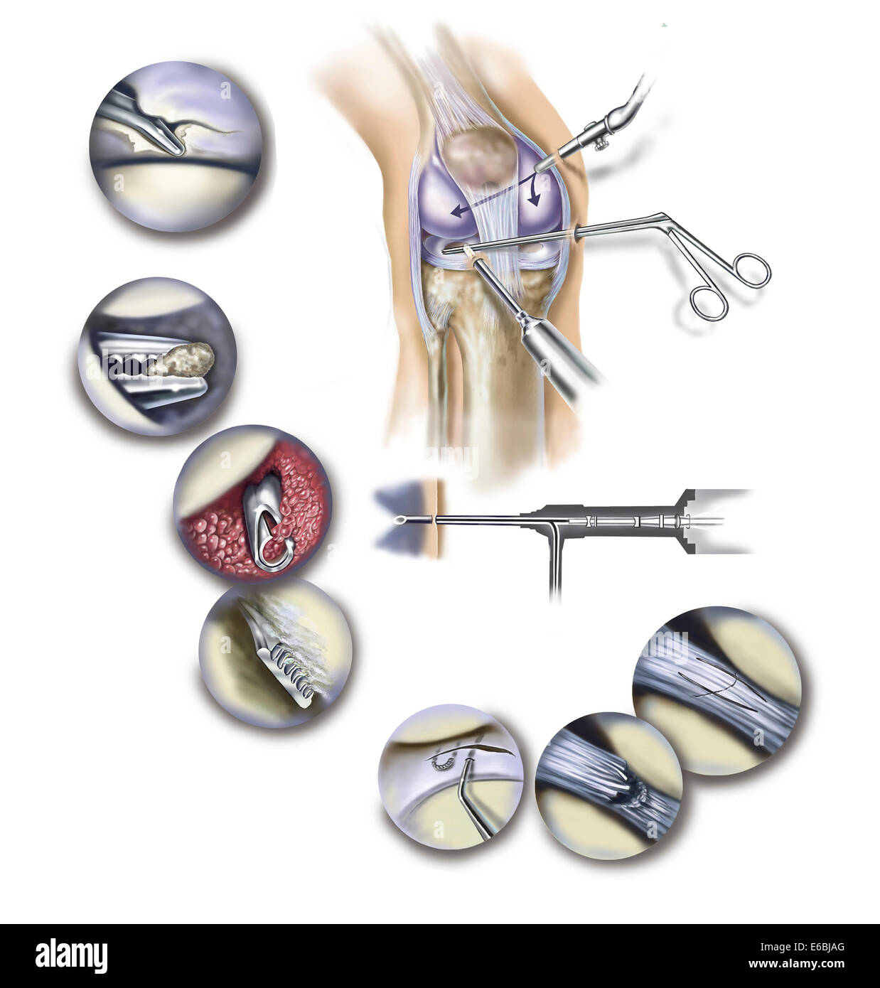 Detail of human knee showing arthroscopic surgical procedures Stock ...