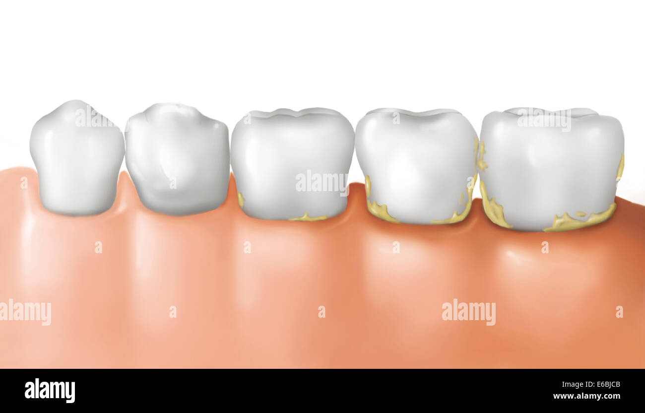 Gingivitis hi-res stock photography and images - Alamy