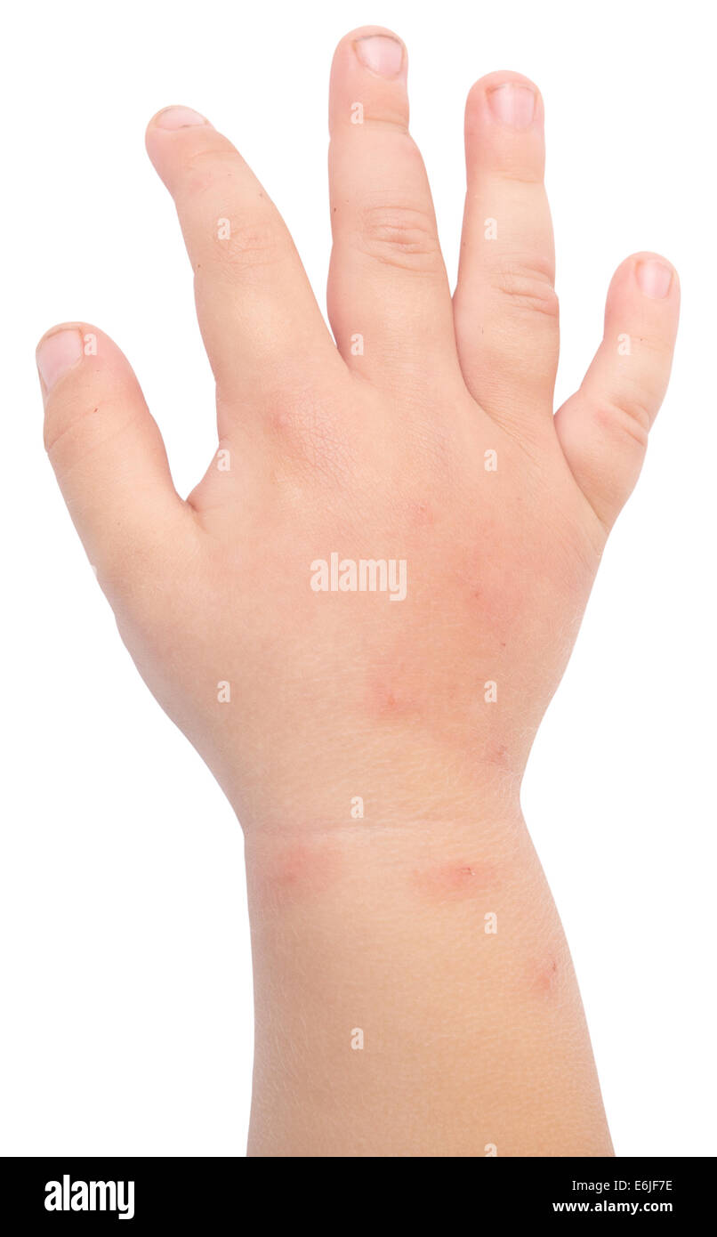 Bug Bite Swelling Hand