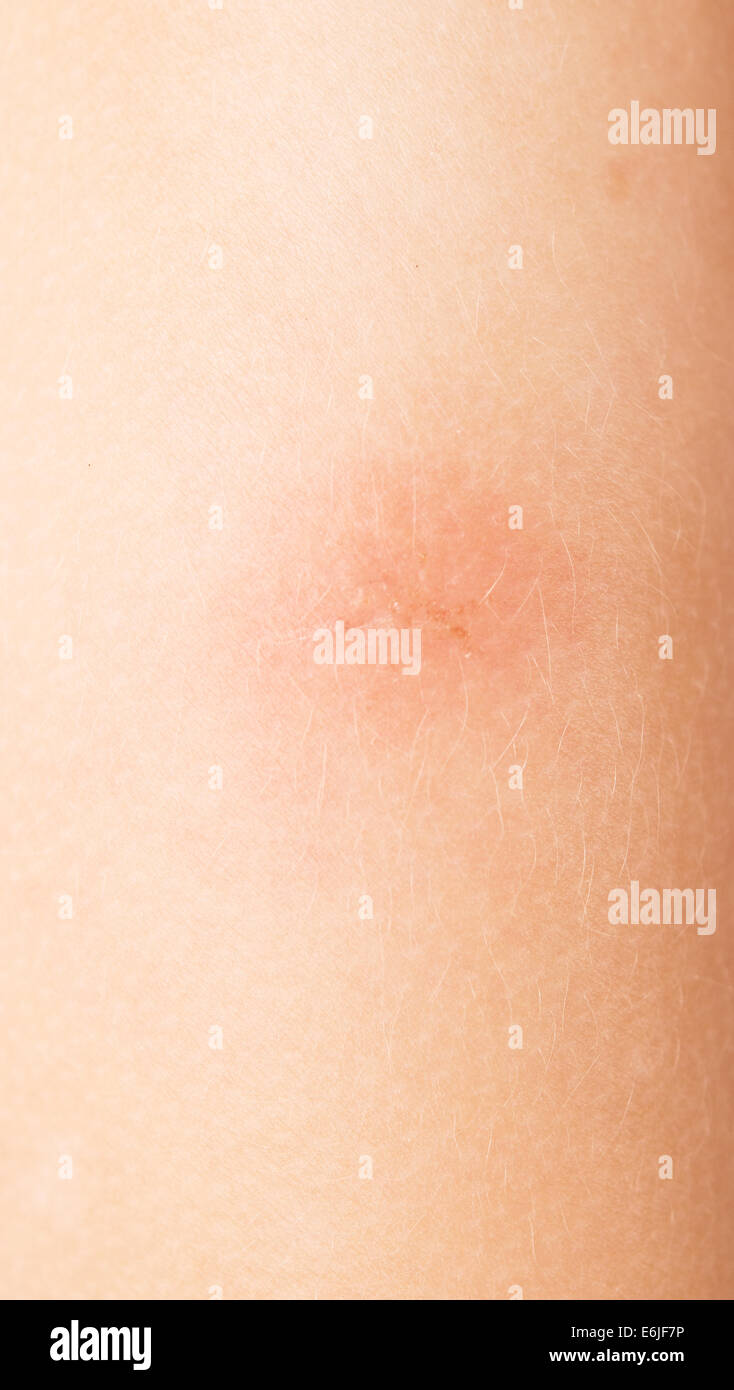 Can A Human Bite Through Skin at Lynn Potter blog