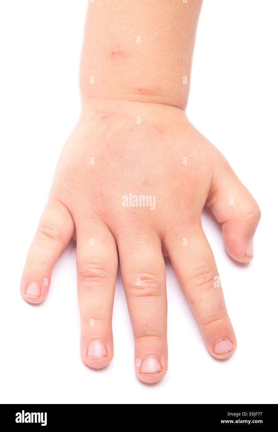 Swollen hand hi-res stock photography and images - Alamy