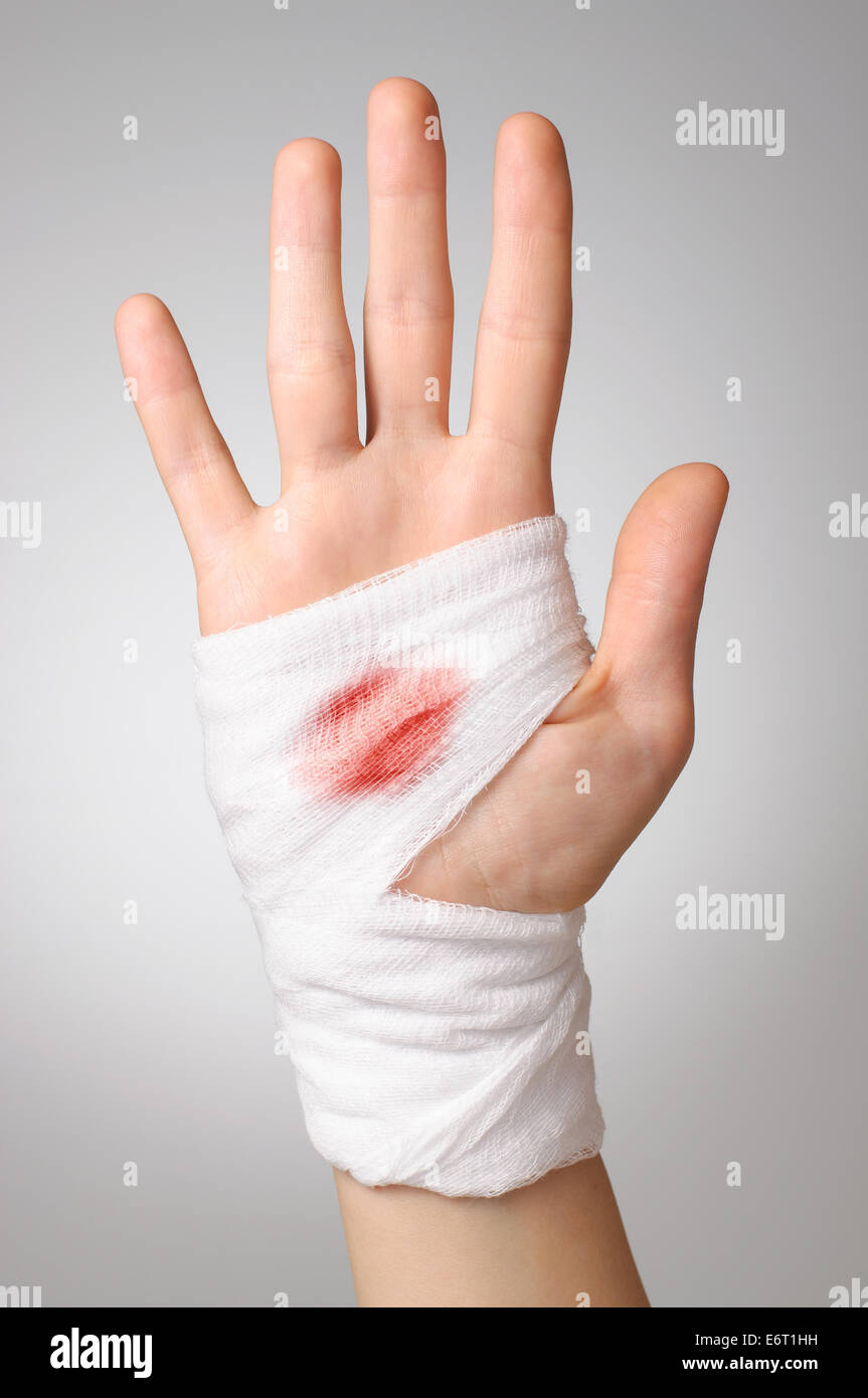 Sliced Hand Accident