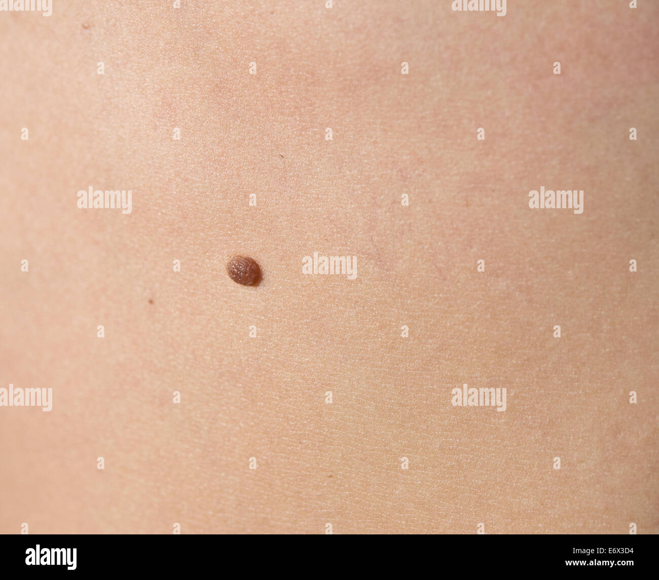 Skin cancer melanoma mole hi-res stock photography and images - Alamy