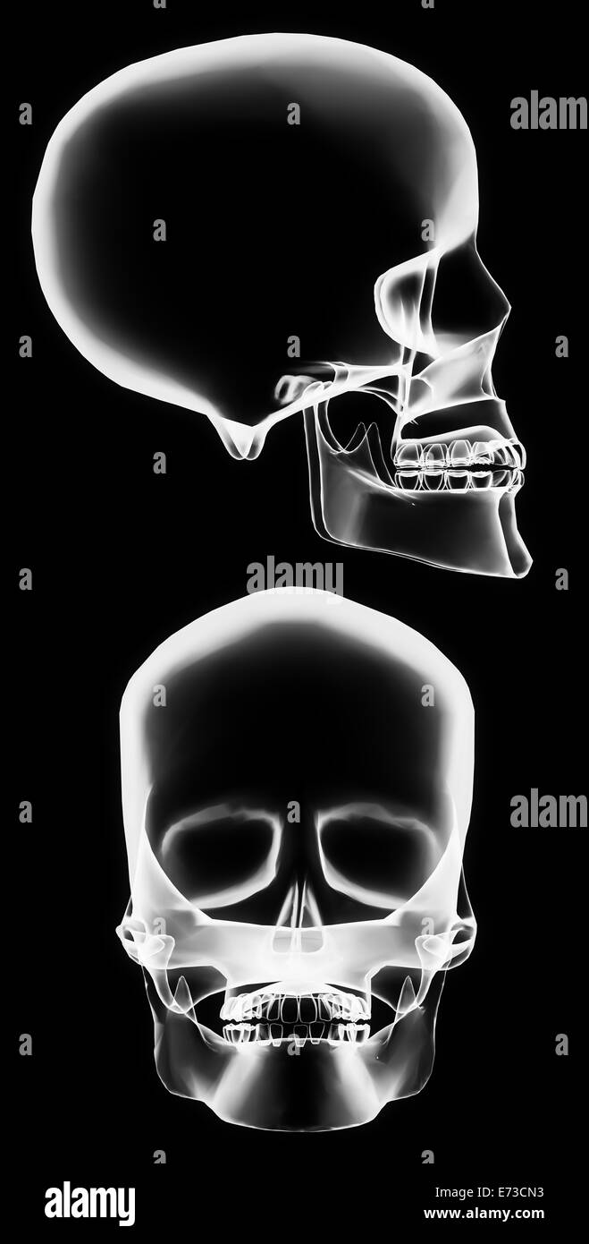 X-ray front and side skull in brightness white with black background ...