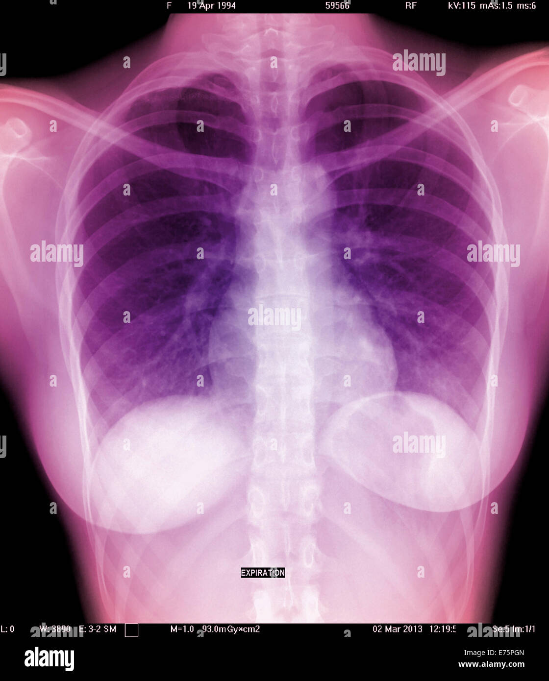 Normal Lungs X Ray Stock Photos & Normal Lungs X Ray Stock Images - Alamy
