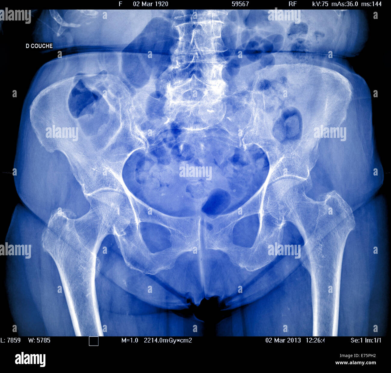 Xray images of normal male hips - petskoti