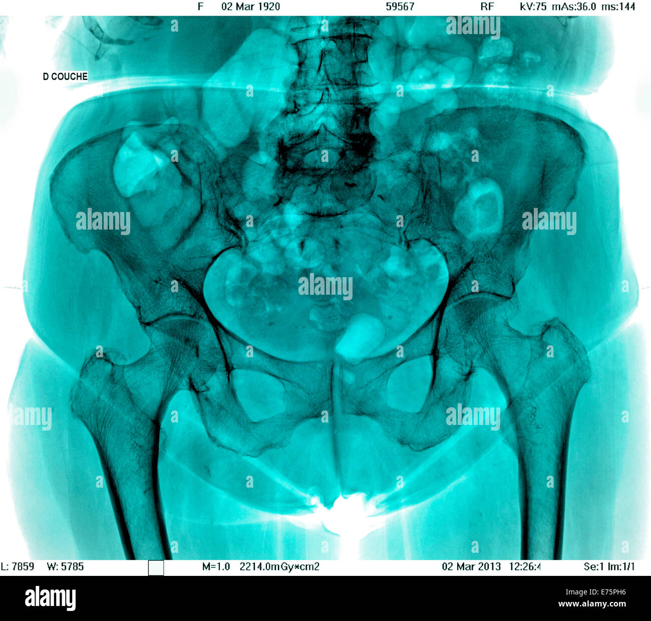 Osteopenia High Resolution Stock Photography and Images - Alamy