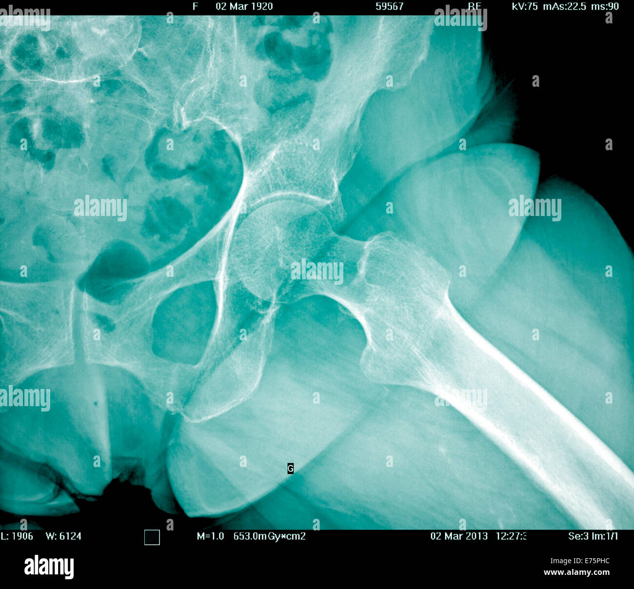 Osteopenia High Resolution Stock Photography and Images - Alamy