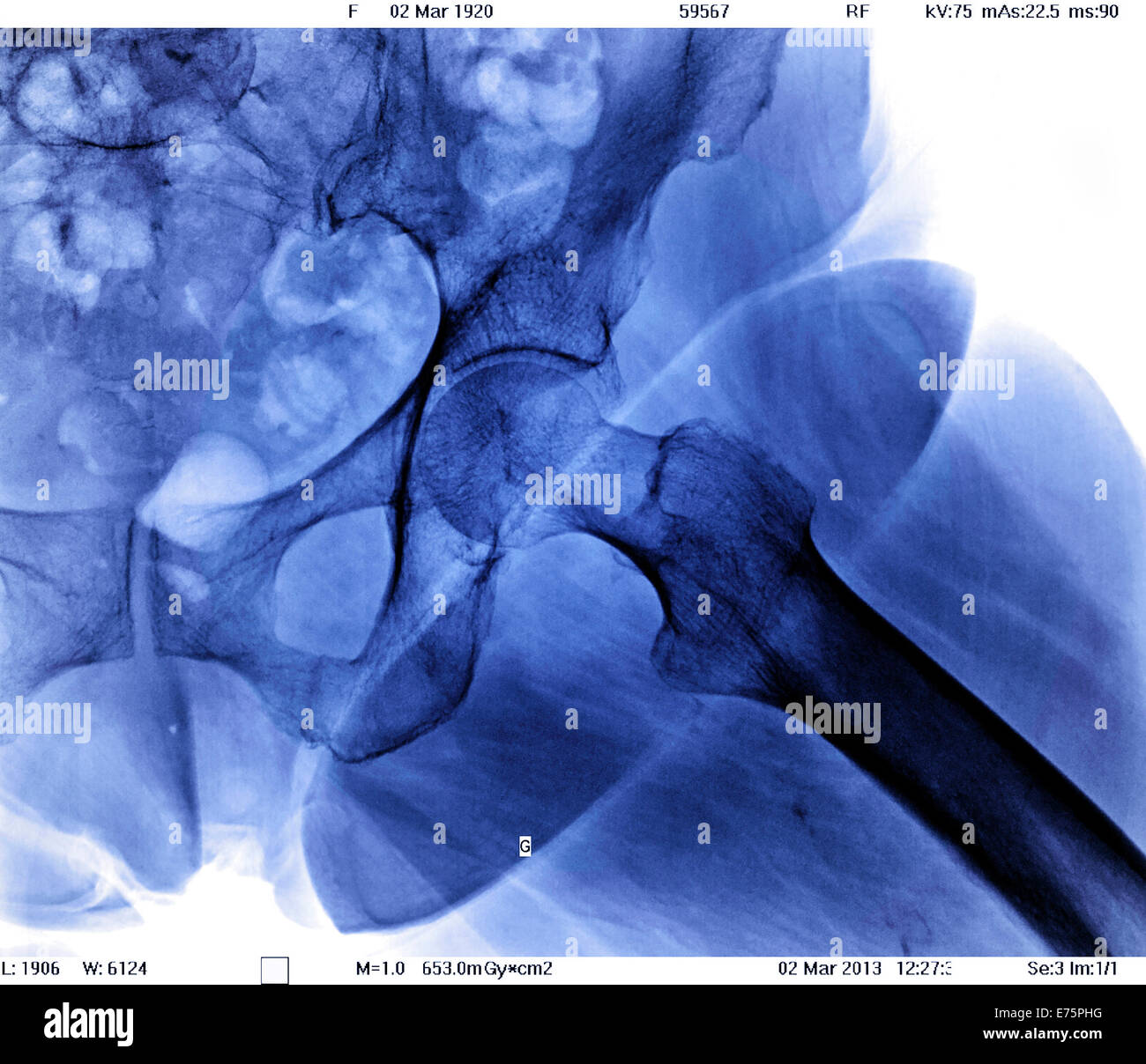 Hip x ray women hi-res stock photography and images - Alamy