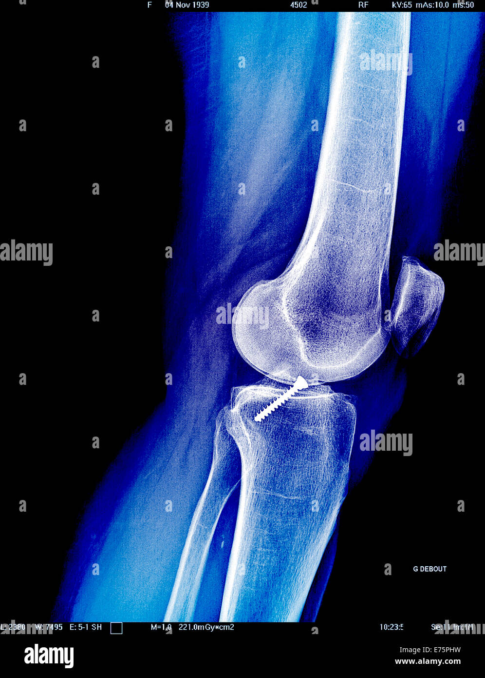X ray bones of the lower limbs hi-res stock photography and images - Alamy