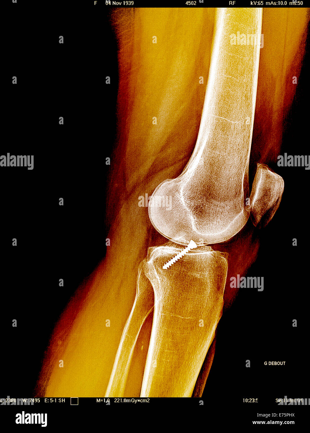 X Ray Of Knee