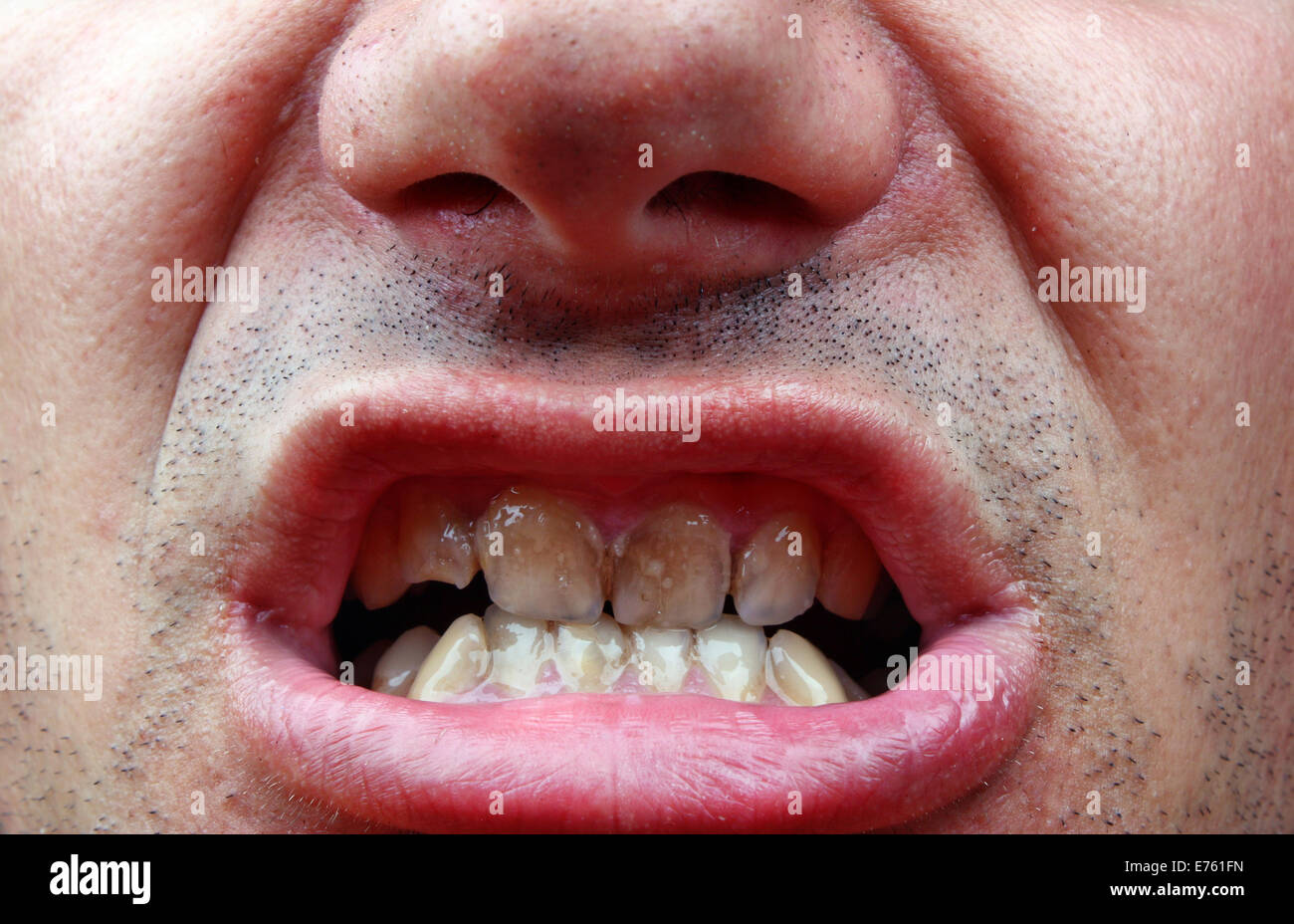 Diseased teeth of the patient. Tartar and tooth decay Stock Photo - Alamy