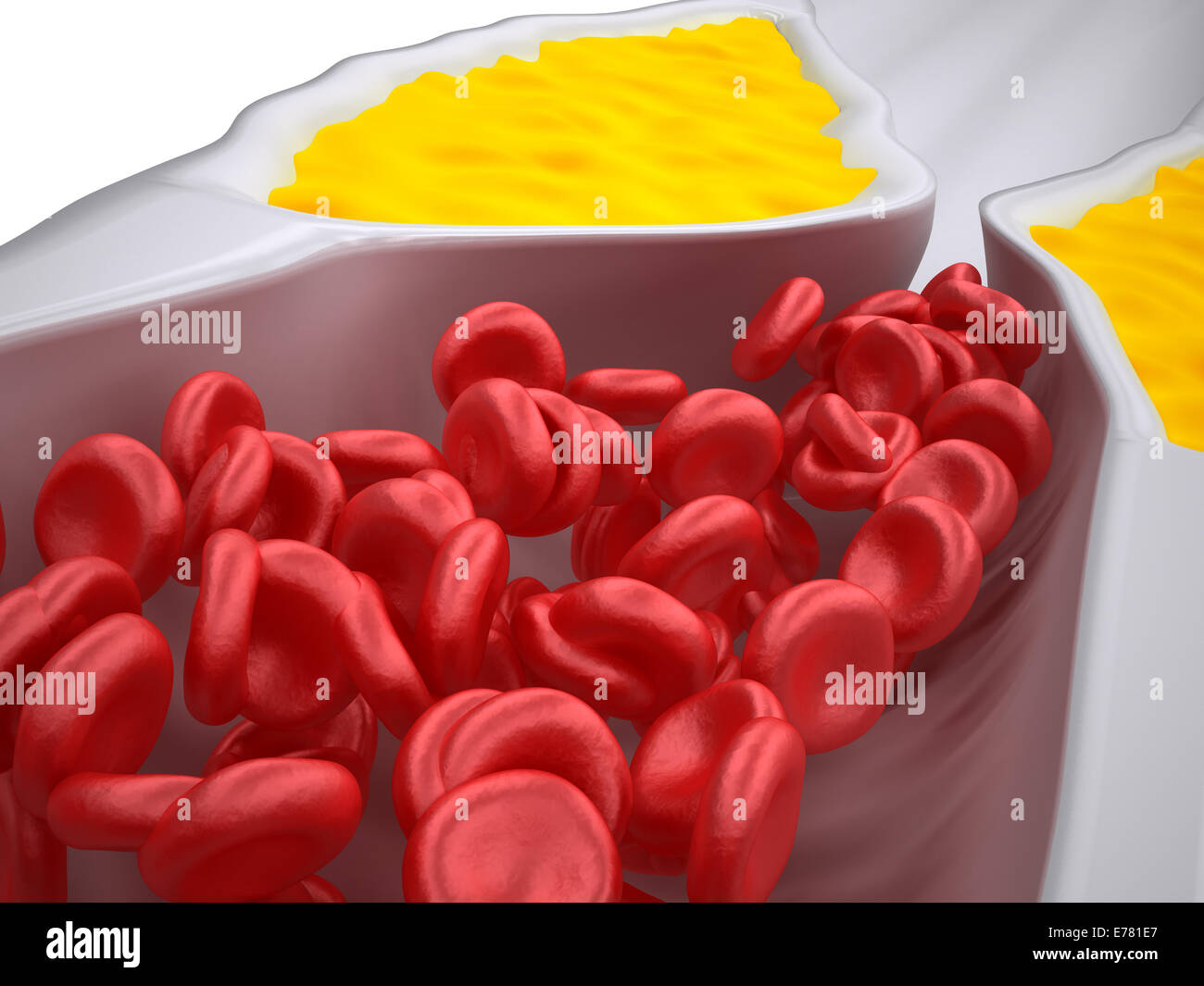 Clogged artery surgery High Resolution Stock Photography and Images - Alamy