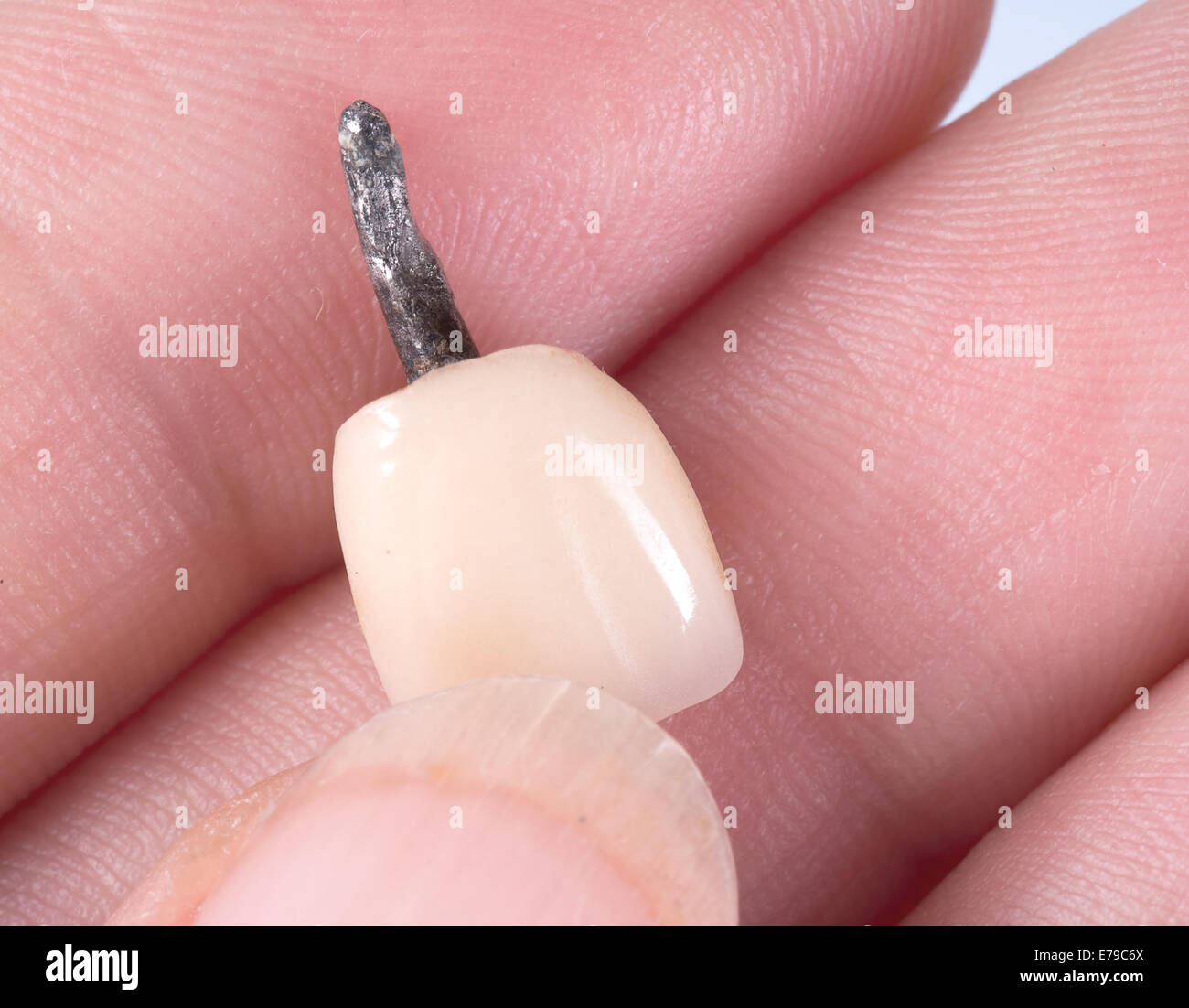 Dentistry. Old false tooth with post Stock Photo - Alamy