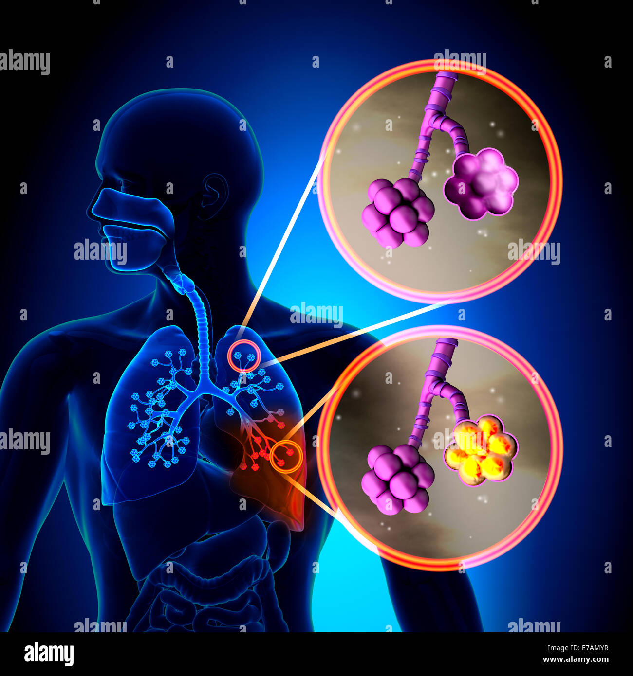 Pneumonia - Normal alveoli vs Pneumonia Stock Photo - Alamy