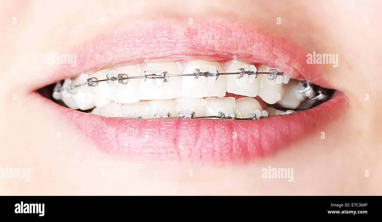 Teeth with braces, beautiful female smile, dental care concept Stock ...