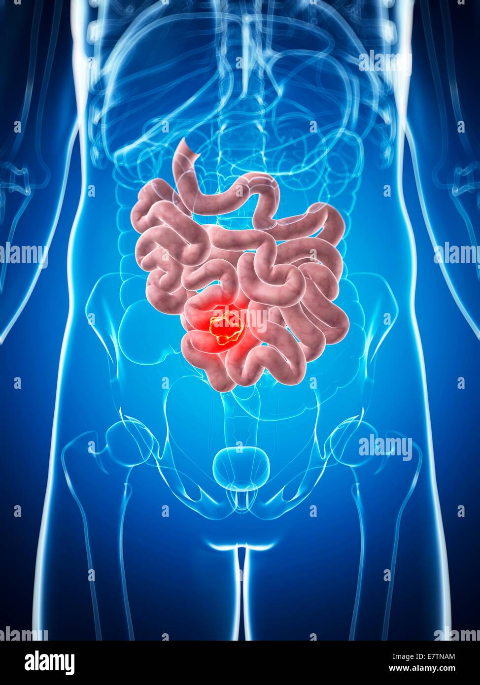 Human bowl cancer hi-res stock photography and images - Alamy