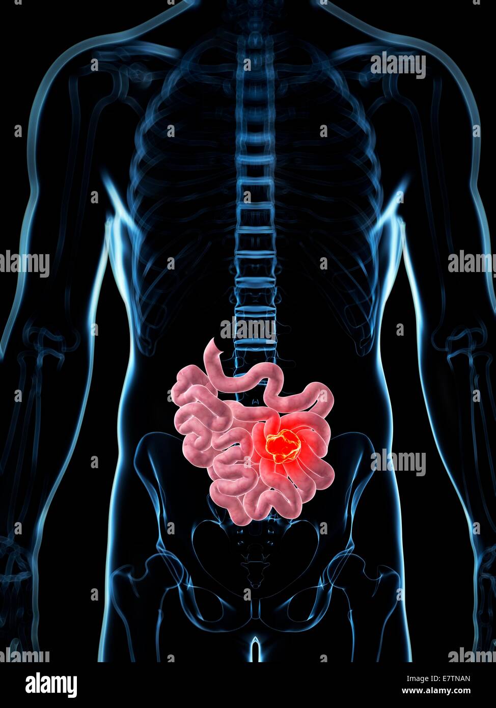 Human bowl cancer, computer artwork Stock Photo - Alamy