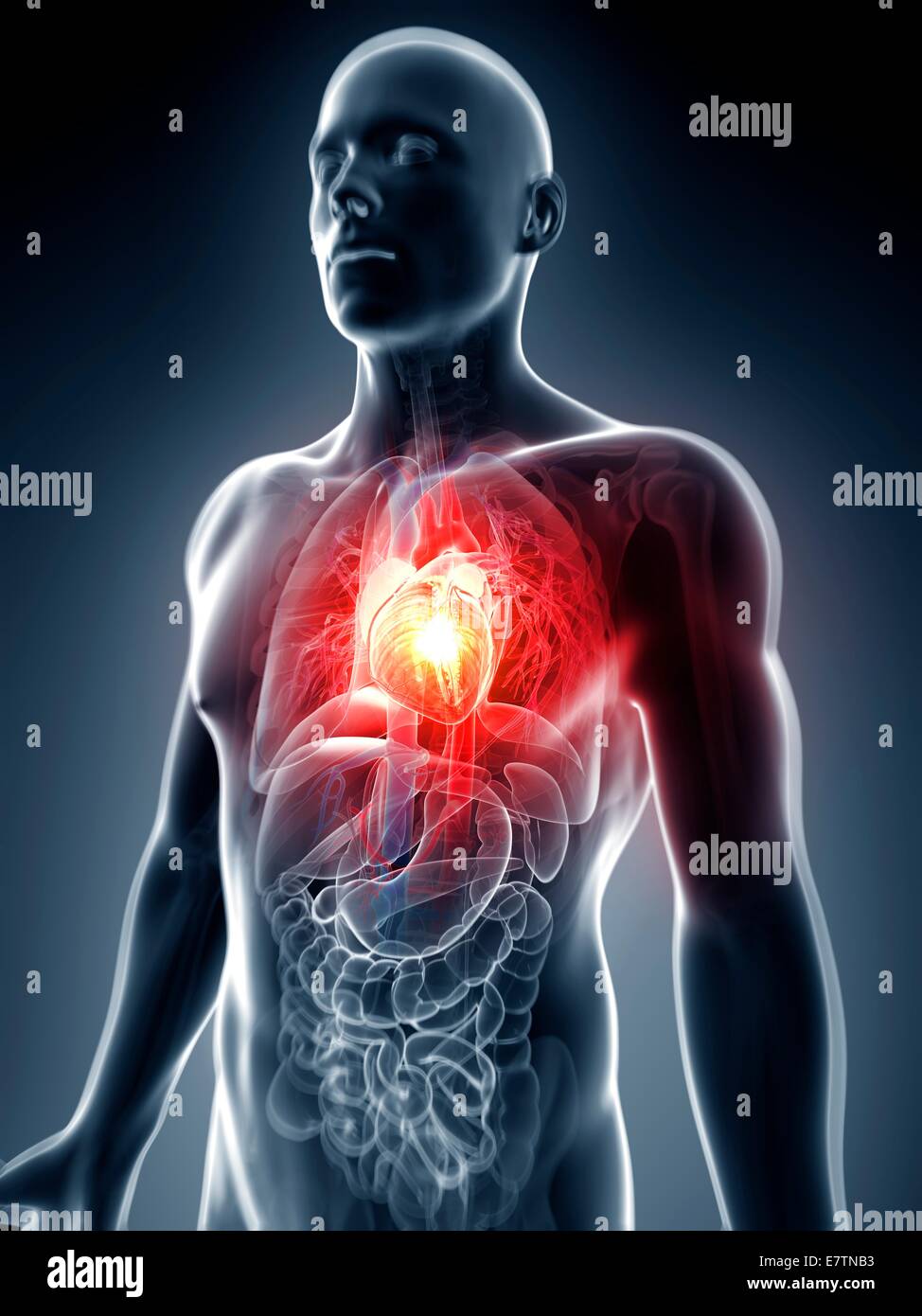 Human heart attack, computer artwork Stock Photo - Alamy
