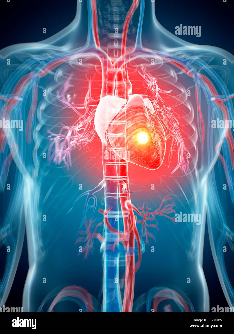 Human heart attack, computer artwork Stock Photo - Alamy