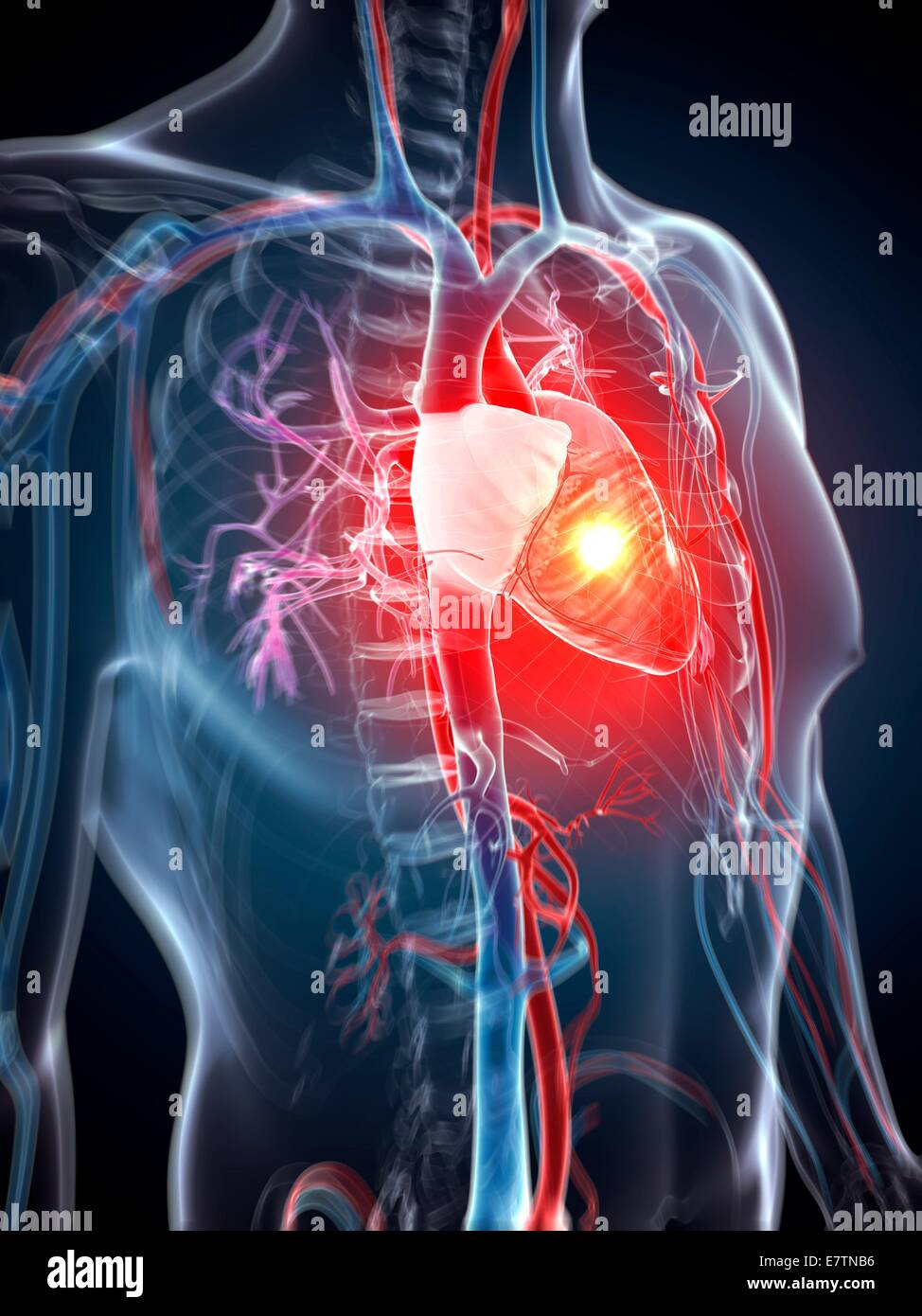 Human heart attack, computer artwork Stock Photo - Alamy