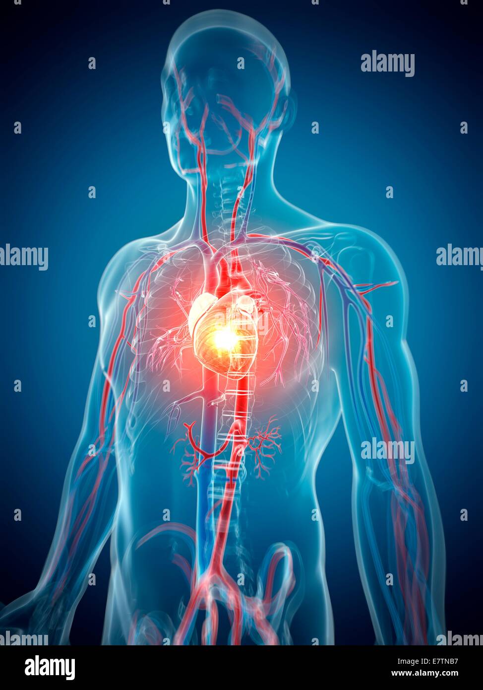 Human heart attack, computer artwork Stock Photo - Alamy
