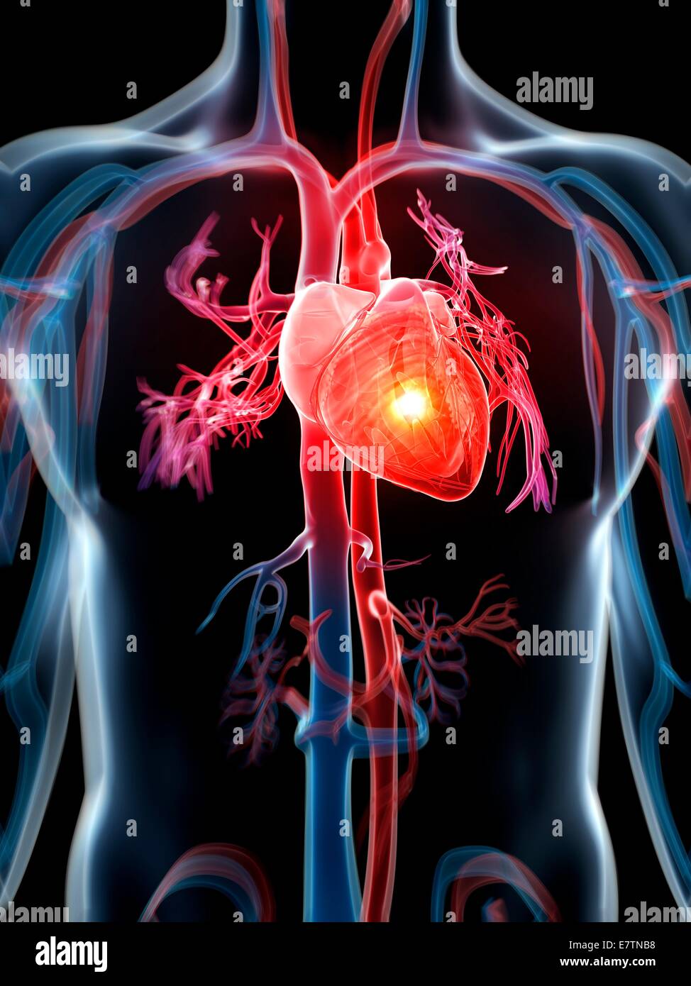 Human heart attack, computer artwork Stock Photo - Alamy