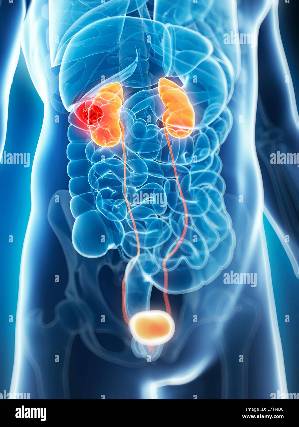 Male kidney cancer, computer artwork Stock Photo - Alamy