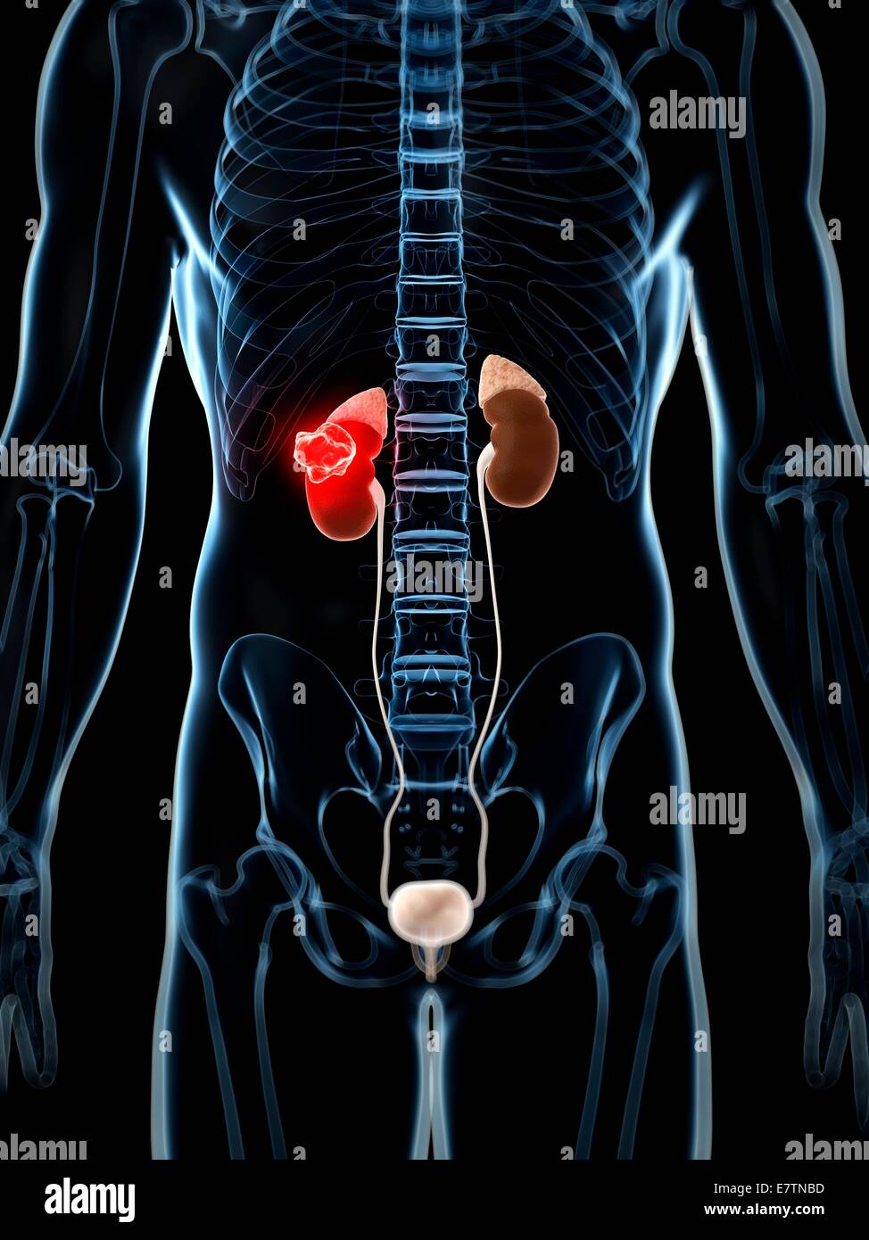 Male kidney cancer hi-res stock photography and images - Alamy