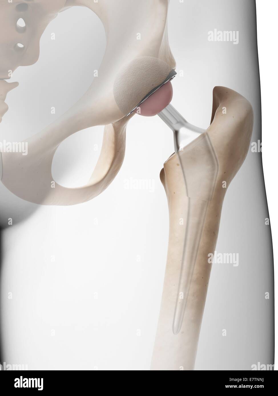 Human hip replacement, computer artwork Stock Photo - Alamy