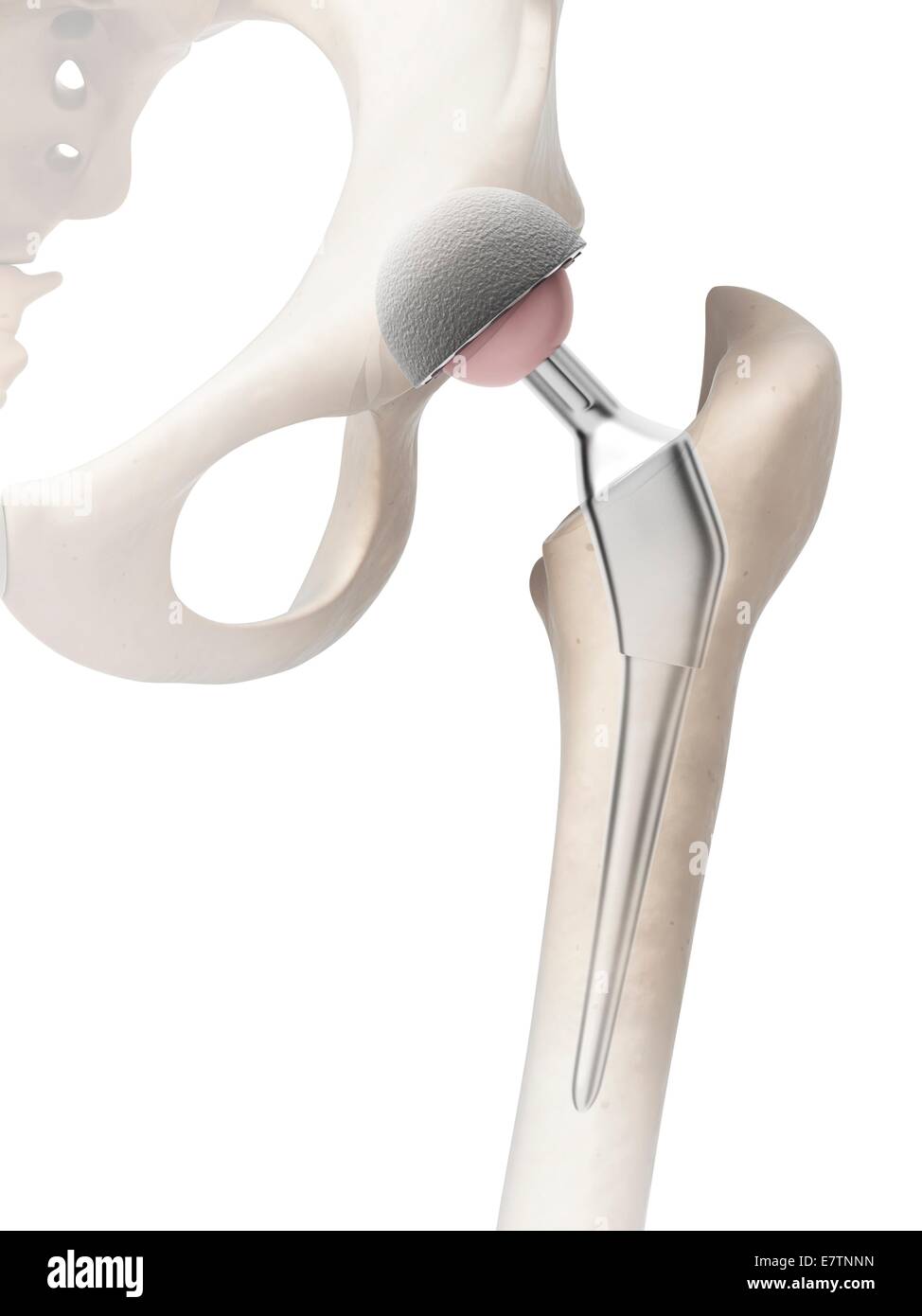 Human hip replacement, computer artwork Stock Photo - Alamy