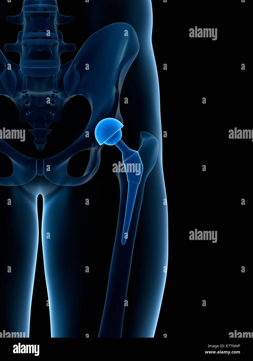 Human hip replacement, computer artwork Stock Photo - Alamy