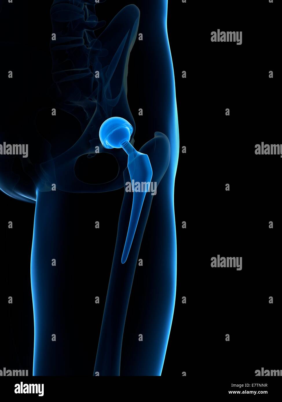 Human hip replacement, computer artwork Stock Photo - Alamy