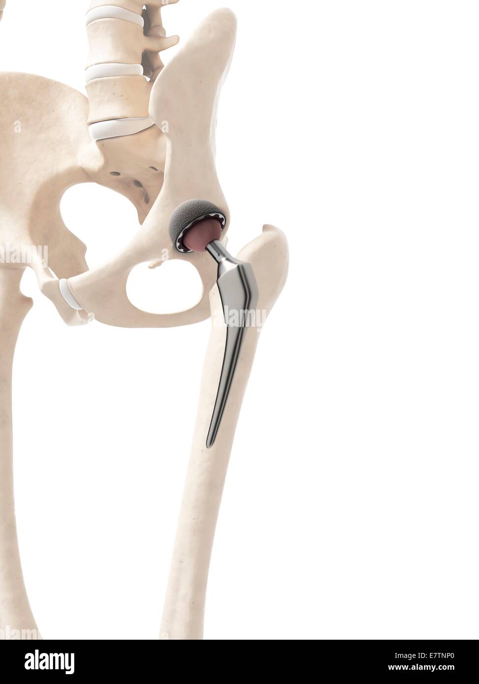 Human hip replacement, computer artwork Stock Photo - Alamy