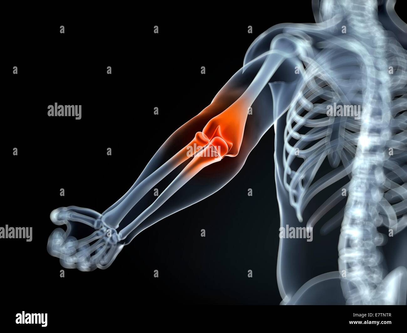 Human elbow joint pain, computer artwork Stock Photo - Alamy