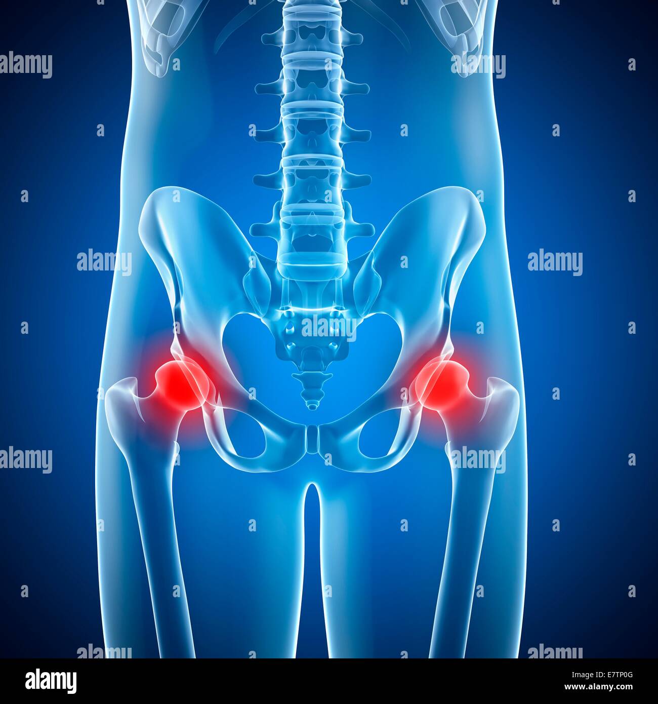 Painful human hip joints, computer artwork Stock Photo - Alamy