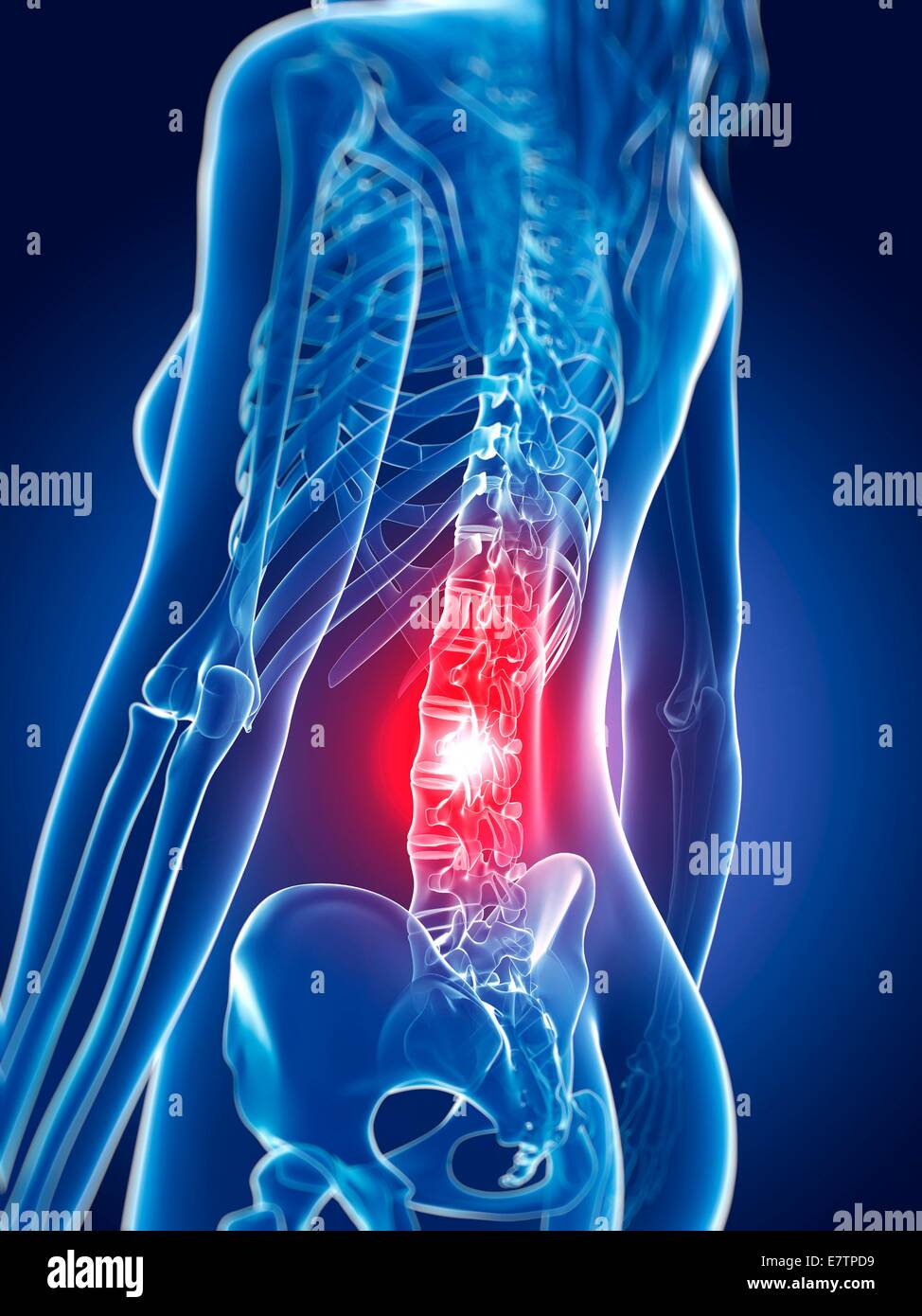 Human back pain, computer artwork Stock Photo - Alamy