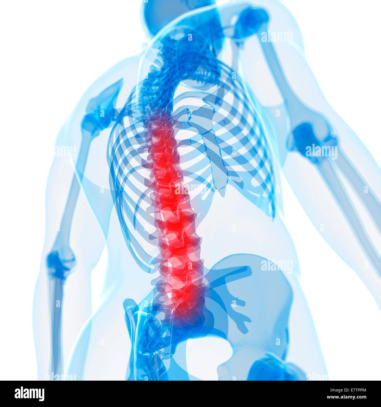 Human back pain, computer artwork Stock Photo - Alamy