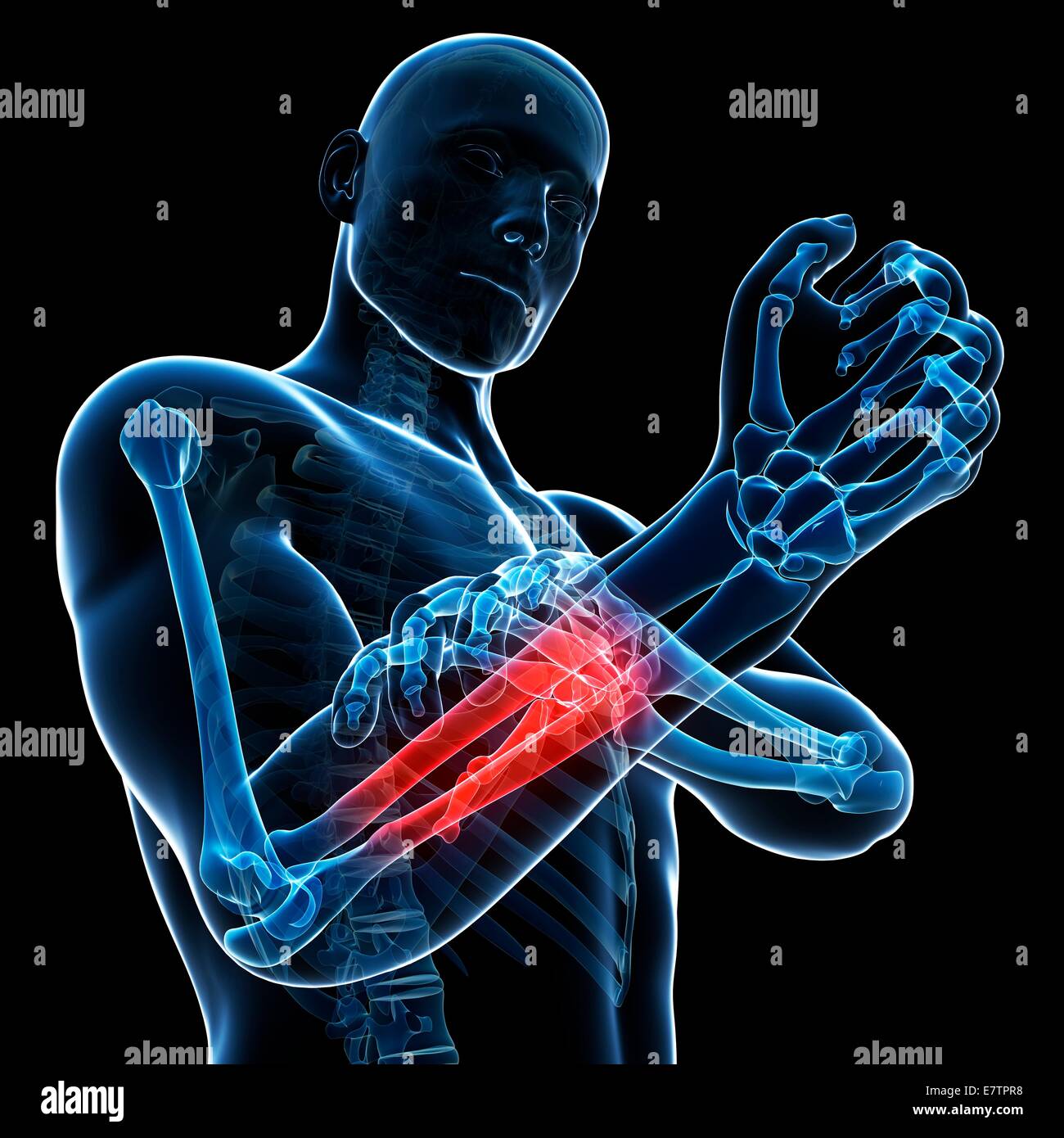 Human forearm bone hi-res stock photography and images - Alamy