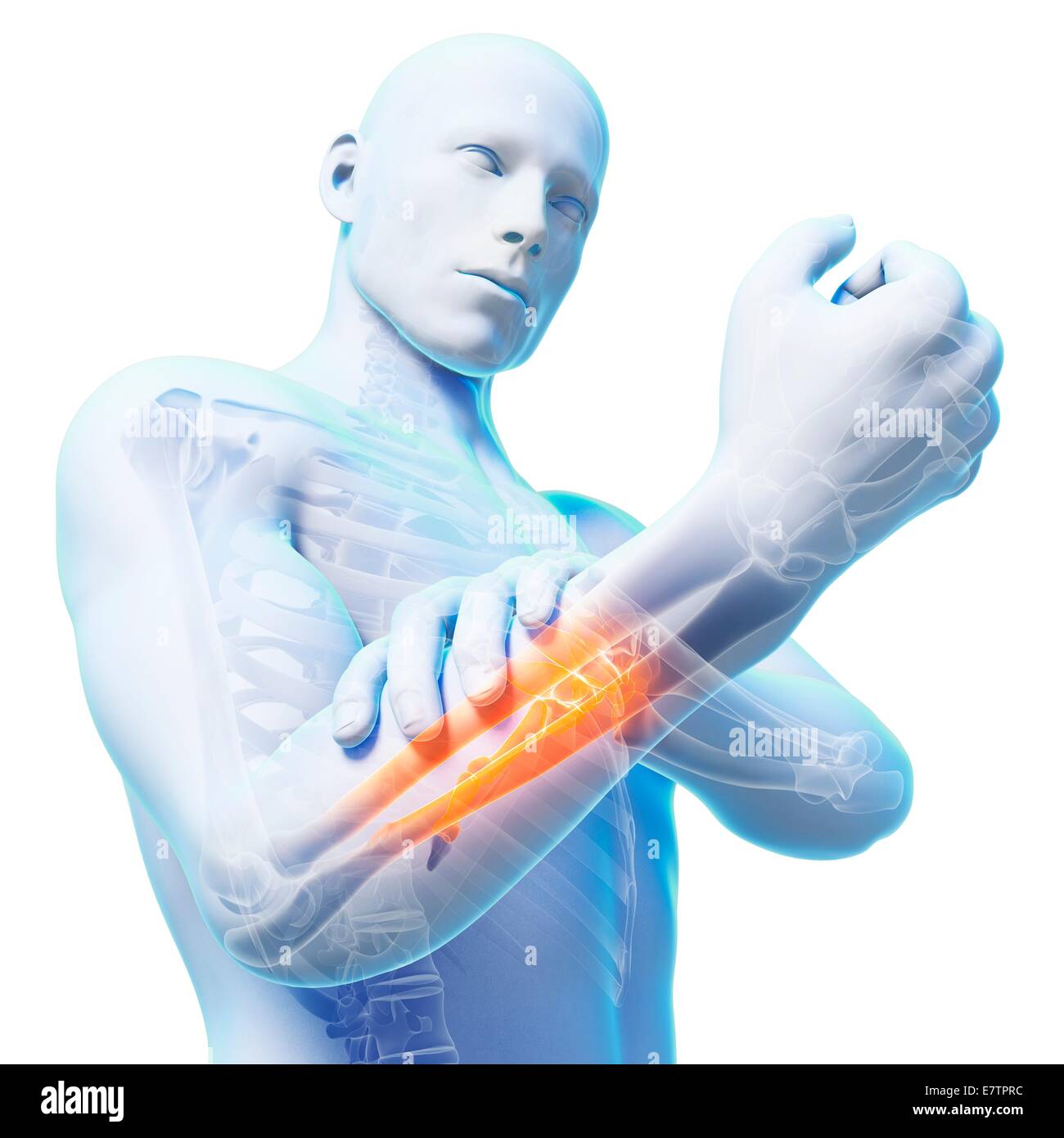 Human arm pain, computer artwork Stock Photo - Alamy