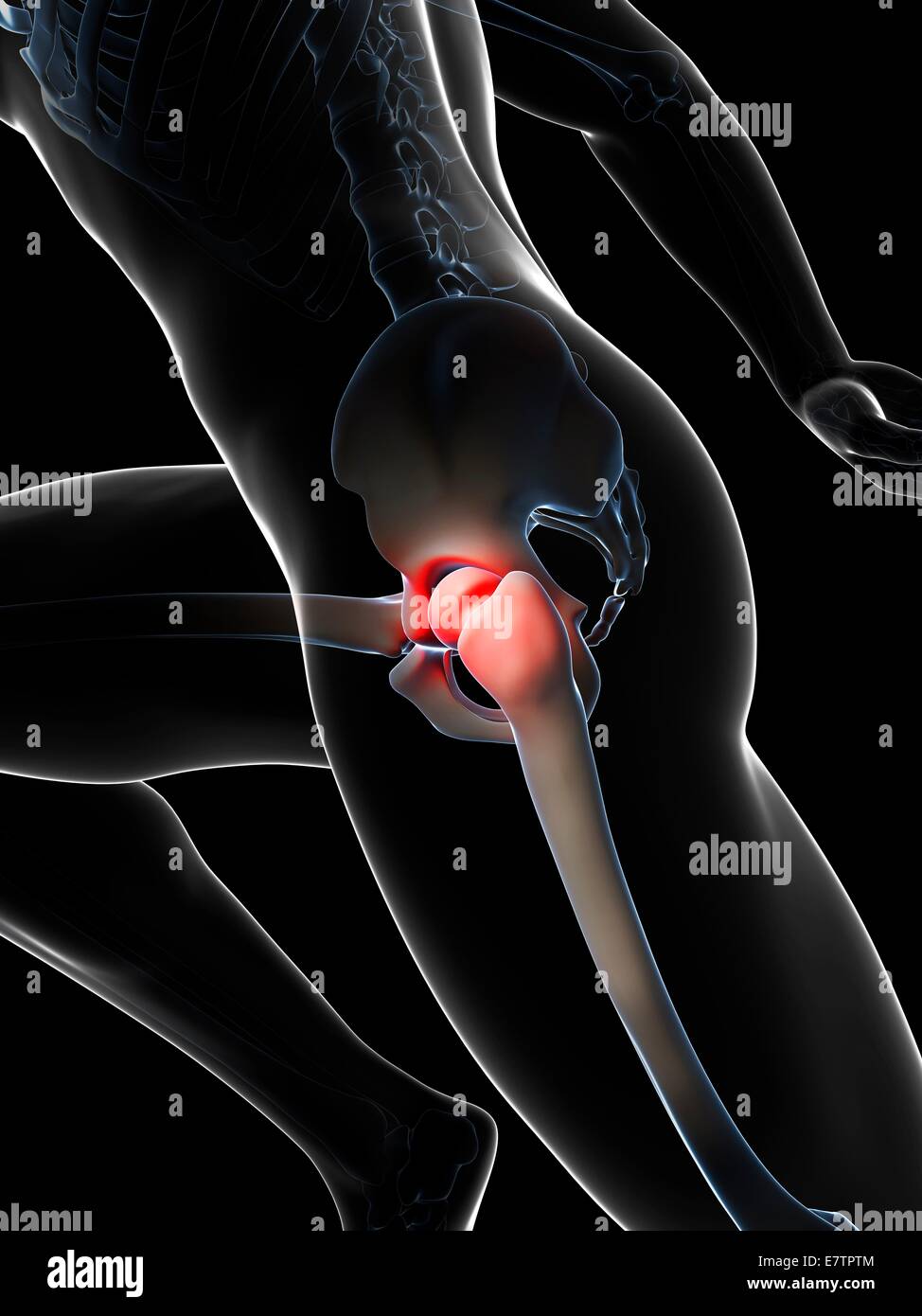 Human hip pain, computer artwork Stock Photo - Alamy