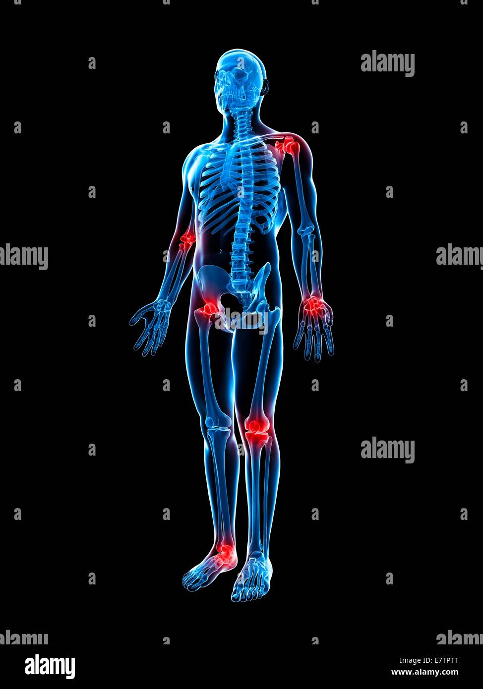 Human joint pain, computer artwork Stock Photo - Alamy